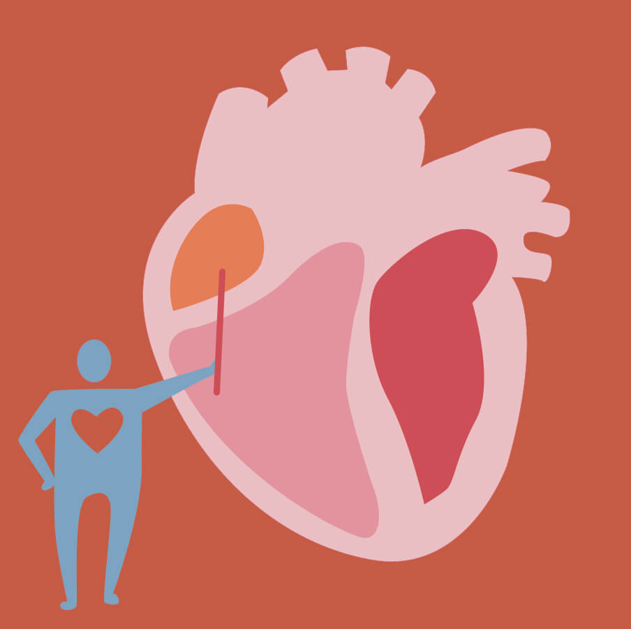 New York Heart Association Classification for Heart Failure